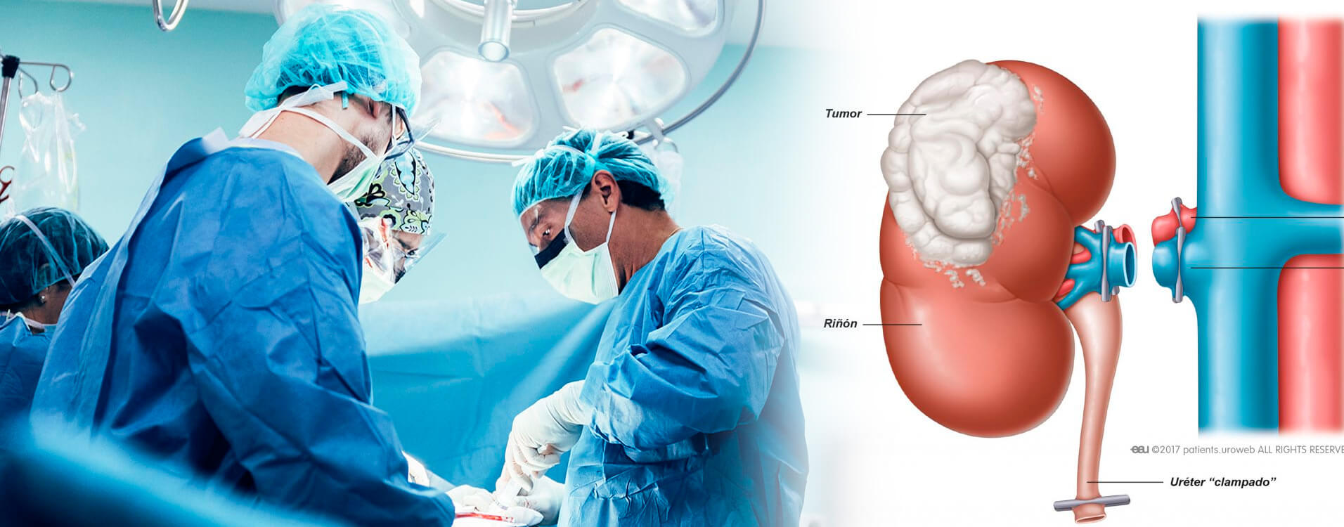Nefrectomía - Urólogo en Guadalajara