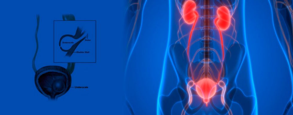 Ureterocele - Urólogo en Guadalajara